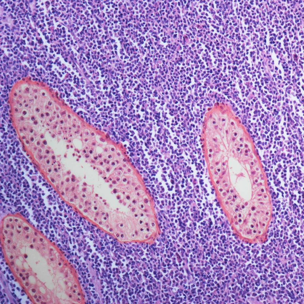 Testicular Cancer | NYU Langone Health