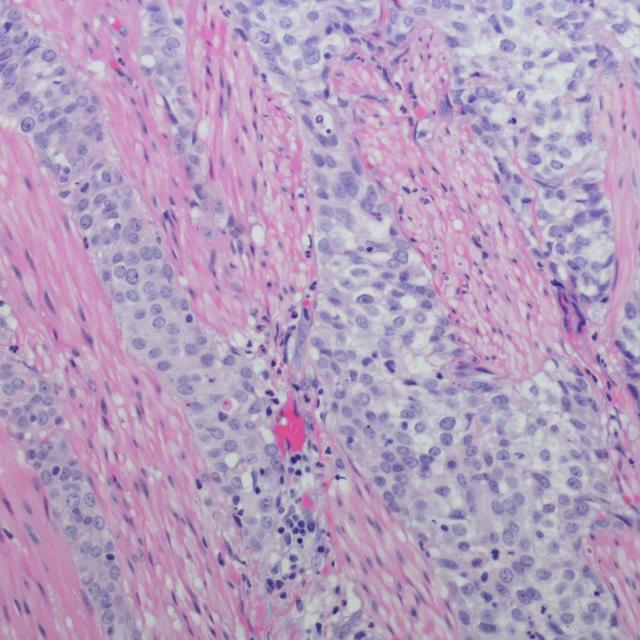 Bladder Cancer | NYU Langone Health