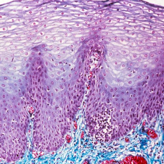 Vaginal Cancer Nyu Langone Health