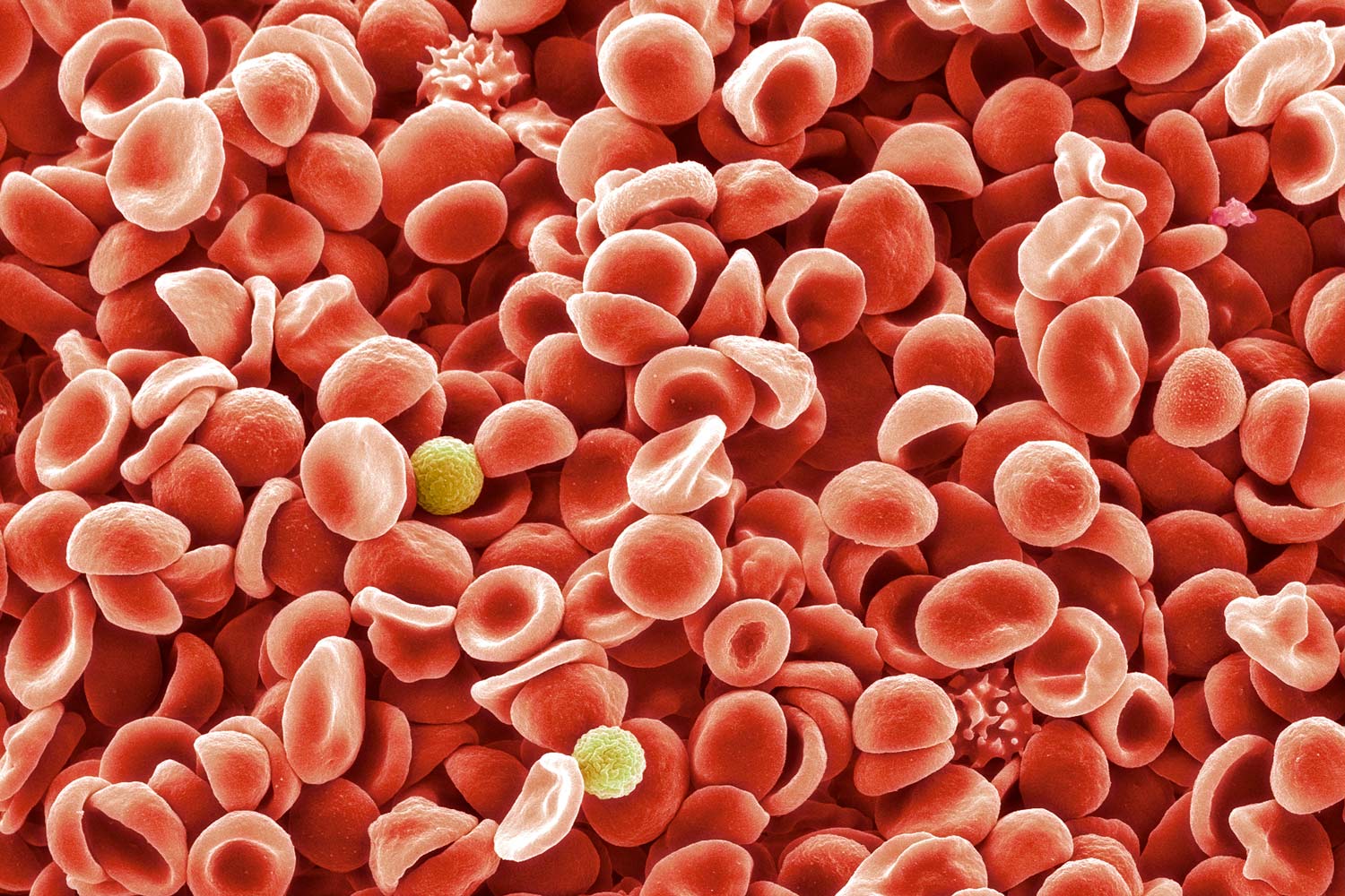 ‘Crowding’ Inside Cells Influences Many Functions & Major Diseases ...