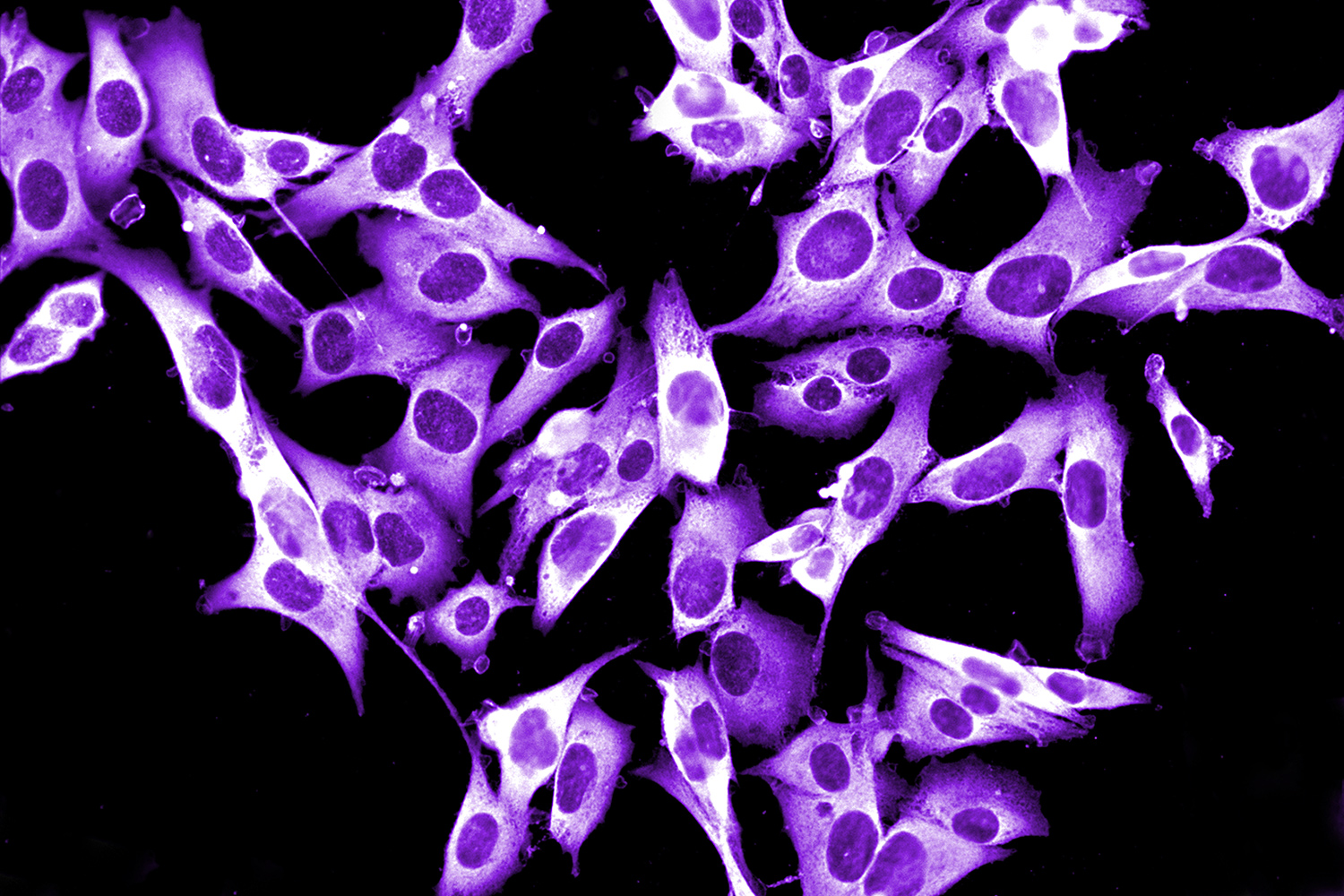 Large SPORE Grant Focuses on Developing Biomarkers to Predict Melanoma ...