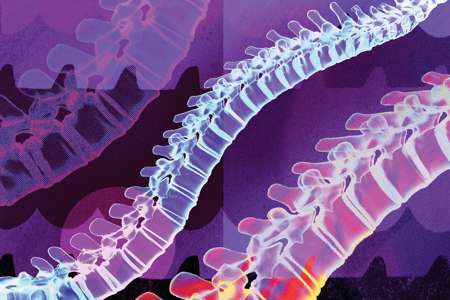 Novel Fusion & Non-Fusion Approaches Improve Surgical Outcomes for ...