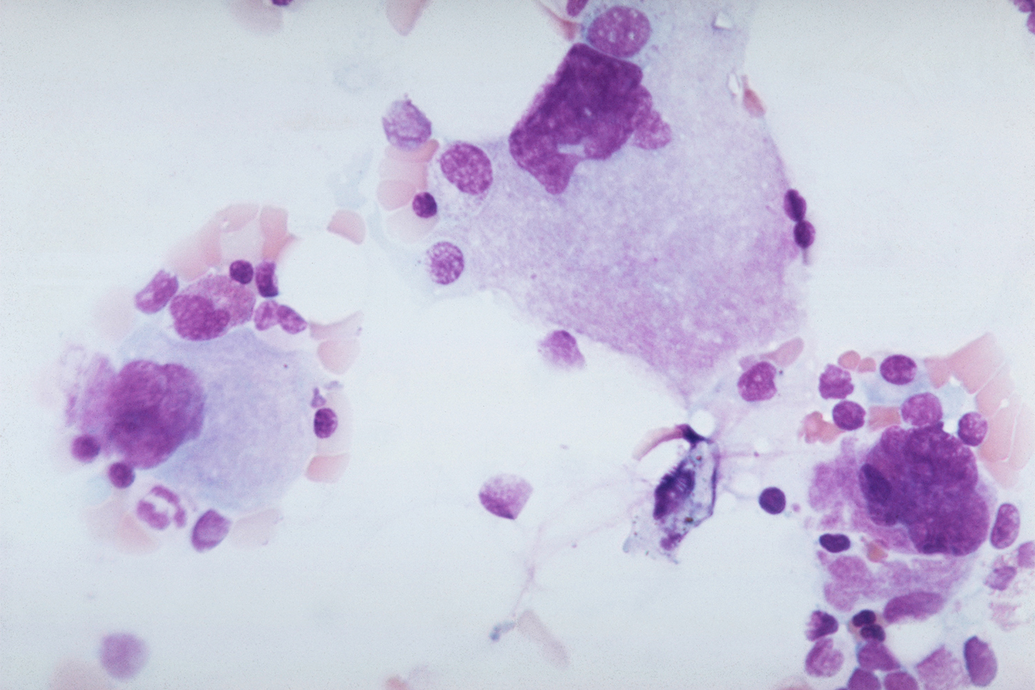 Antiphospholipid Syndrome Resolved for Patient with Lupus & Genetic ...