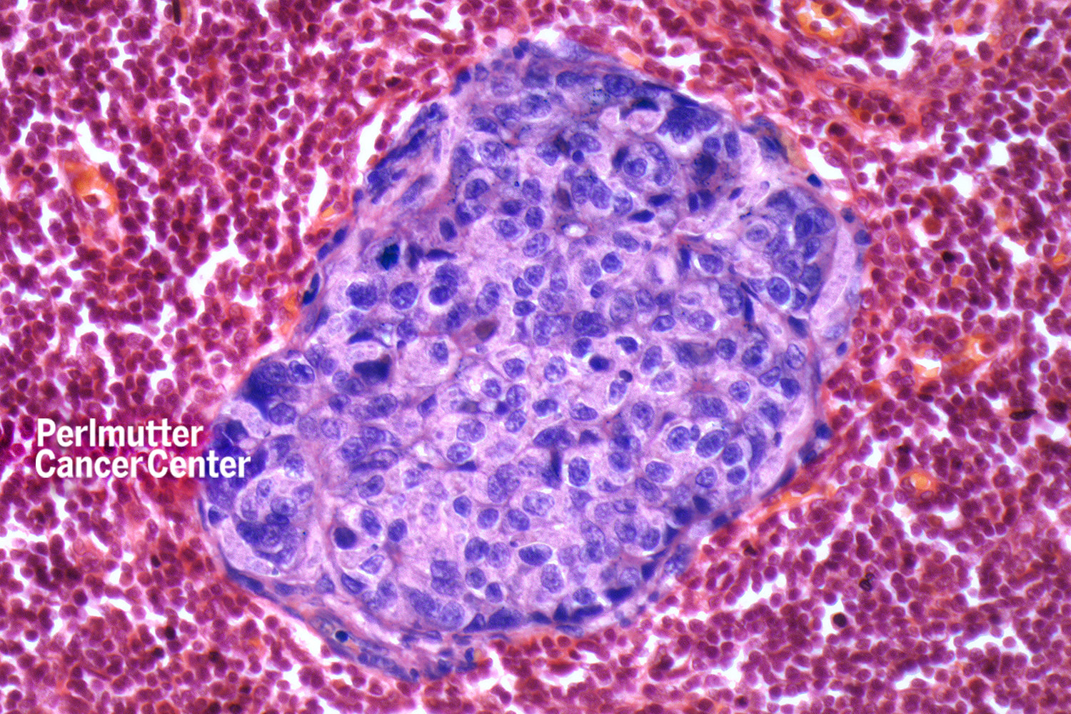 ABC7NY: Perlmutter Cancer Center Patient Shares Her Story of a ...