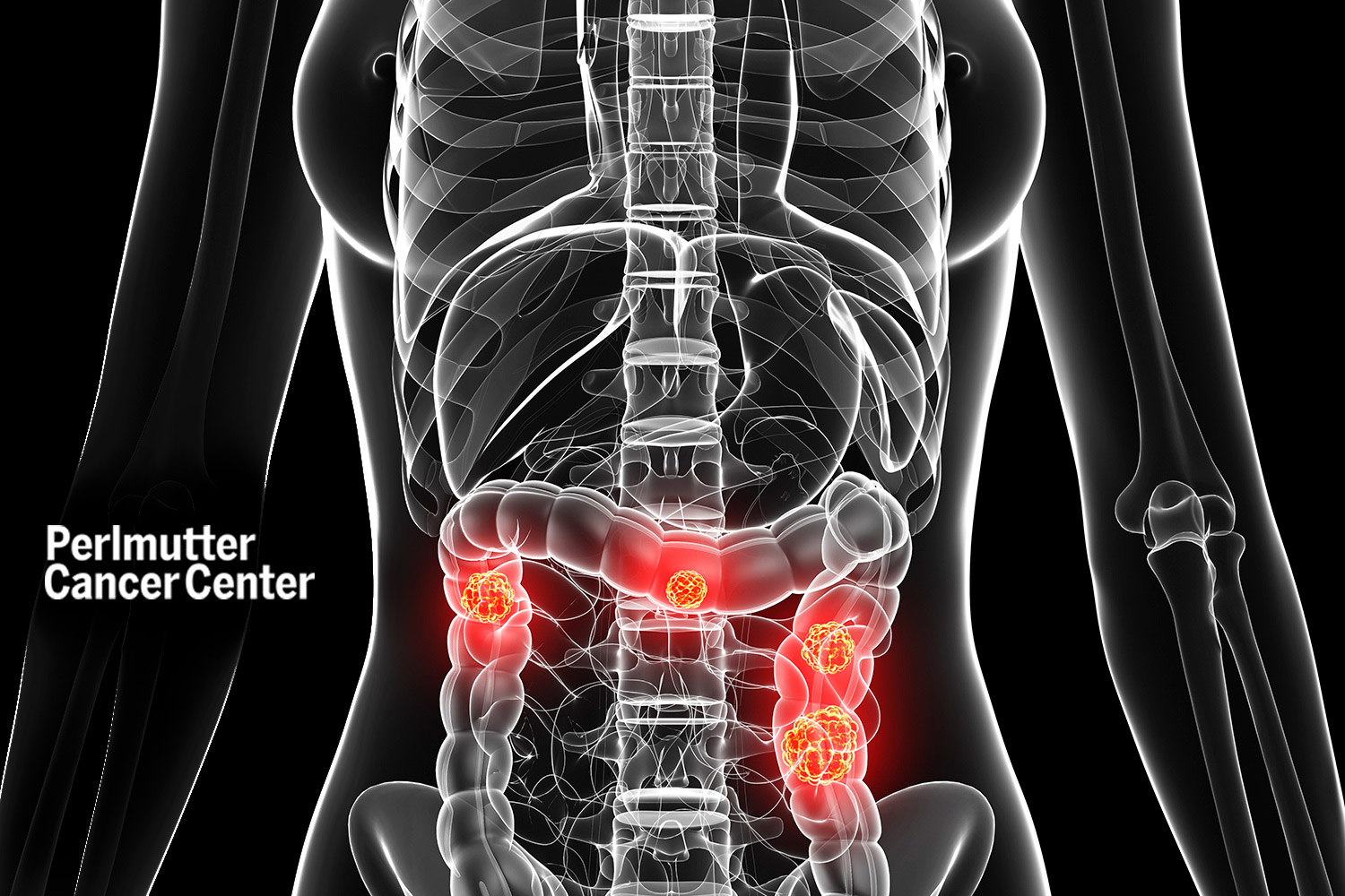 HealthCentral: Perlmutter Cancer Center Medical Oncologist Shares 10 ...