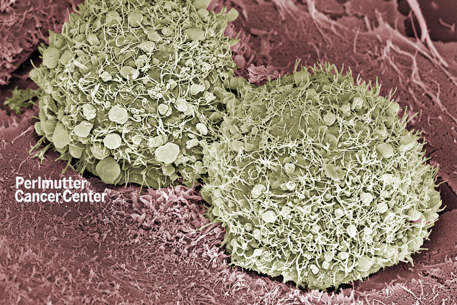 Perlmutter Cancer Center Surgeon Discusses Early Detection, Improving ...