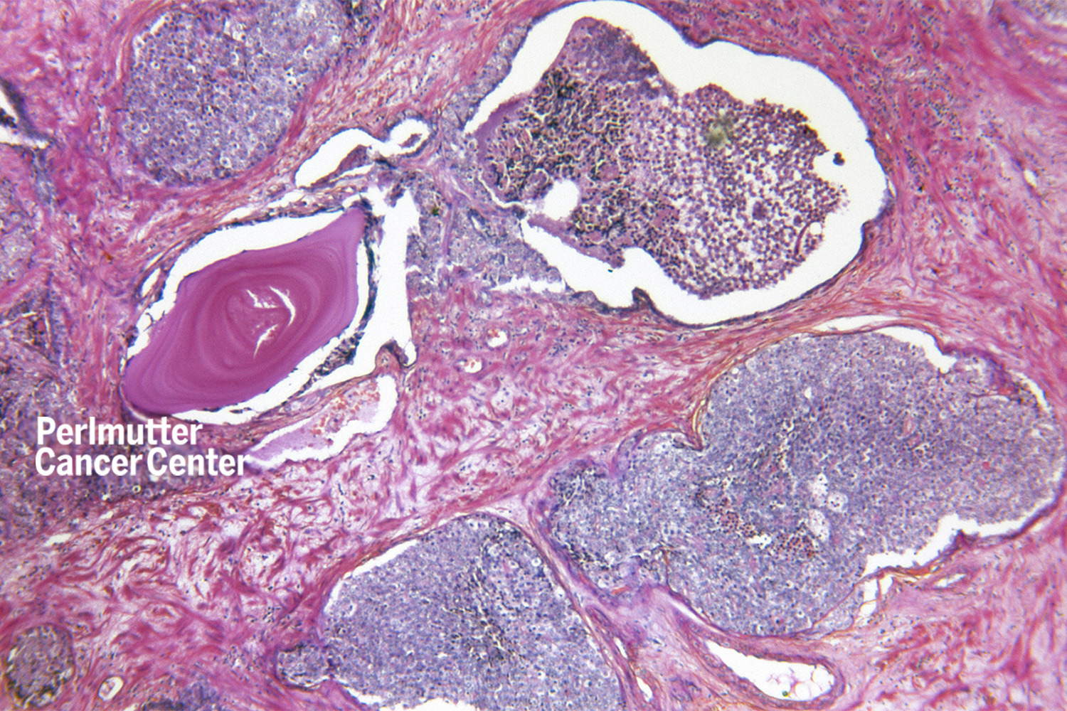 ACCCBuzz: Perlmutter Cancer Center Medical Oncologist Discusses ...