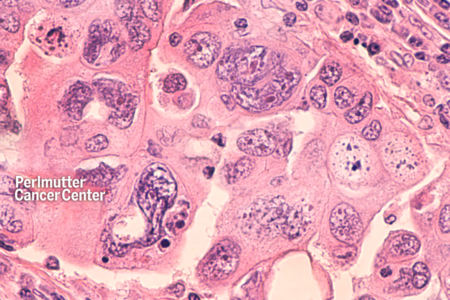 Healio HemOnc Today: Perlmutter Cancer Center Gynecologic Oncologist ...
