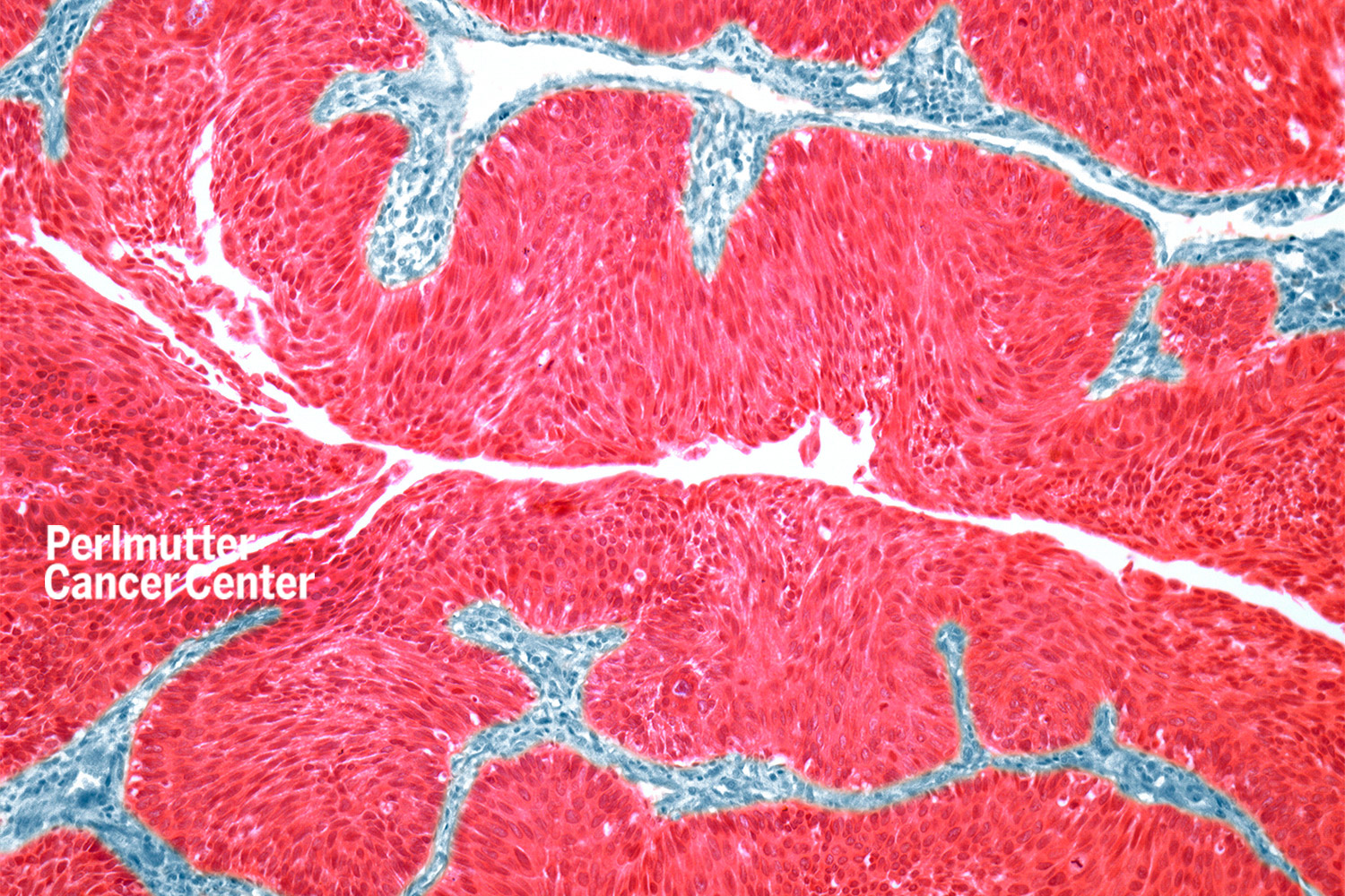 Perlmutter Cancer Center Clinical Trial Tests New Method of Treating ...
