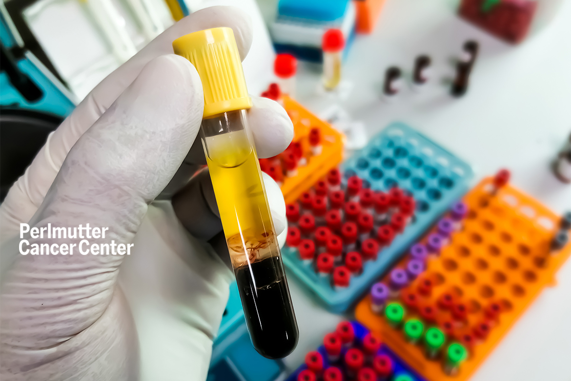 Perlmutter Cancer Center Clinical Trials Test Targeted Treatments for ...