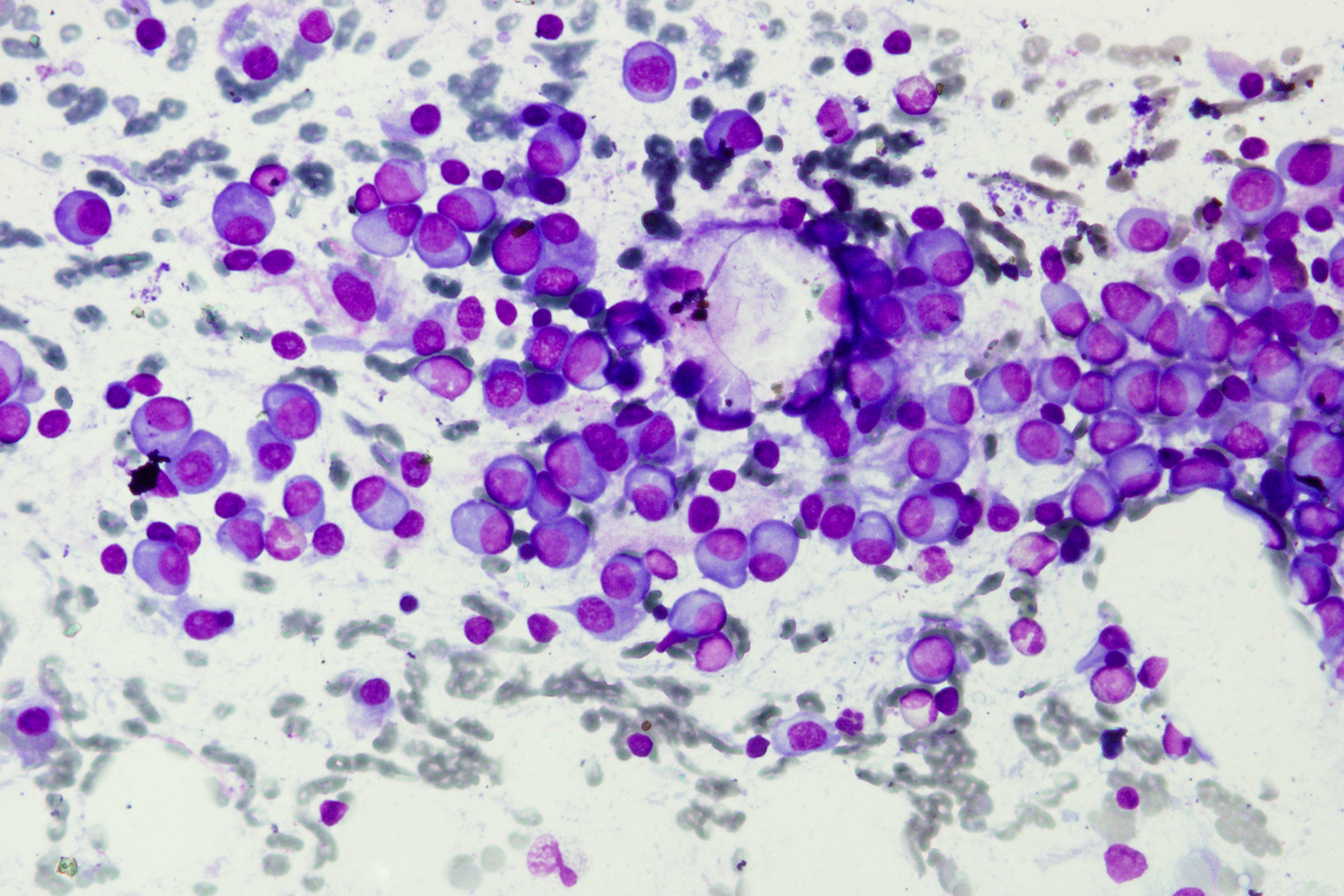 New Hybrid Treatment Forces Cancer Cells to Starve | NYU Langone News