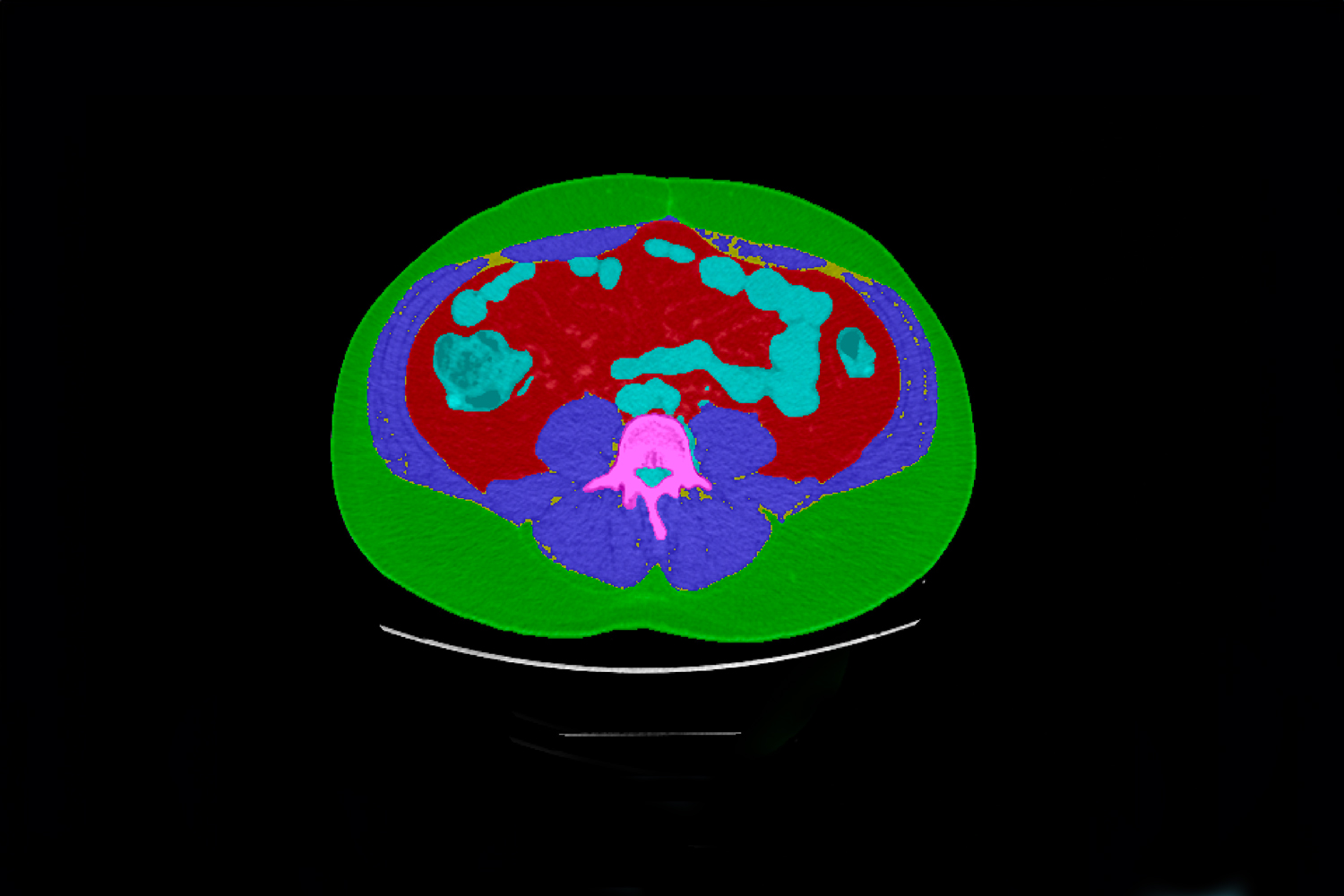 Mining Medical Scans for Clues to Prevent & Detect Diseases | NYU ...