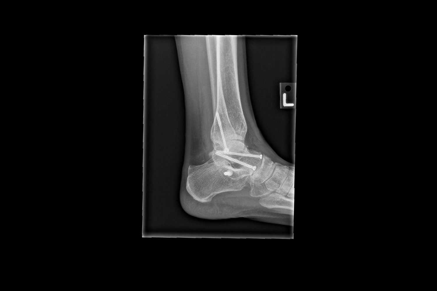 Rock Climber Back on Her Feet After Traumatic Injuries in Death-Defying ...