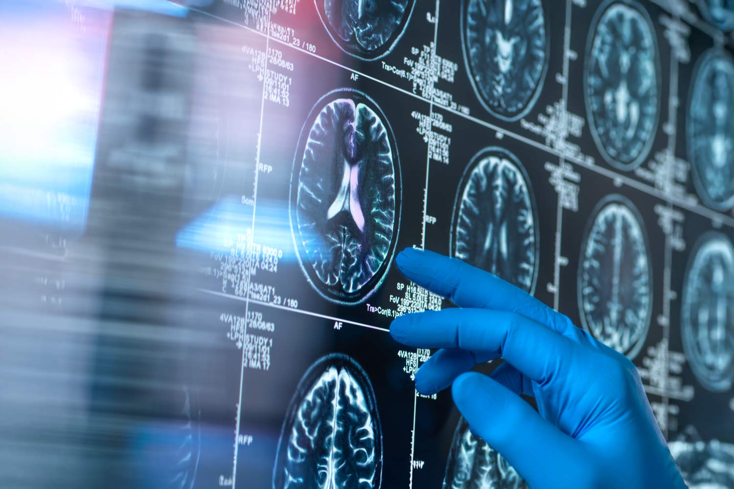 Newfound Circuit Better Explains How the Brain Recognizes What Is Familiar & Important | NYU ...