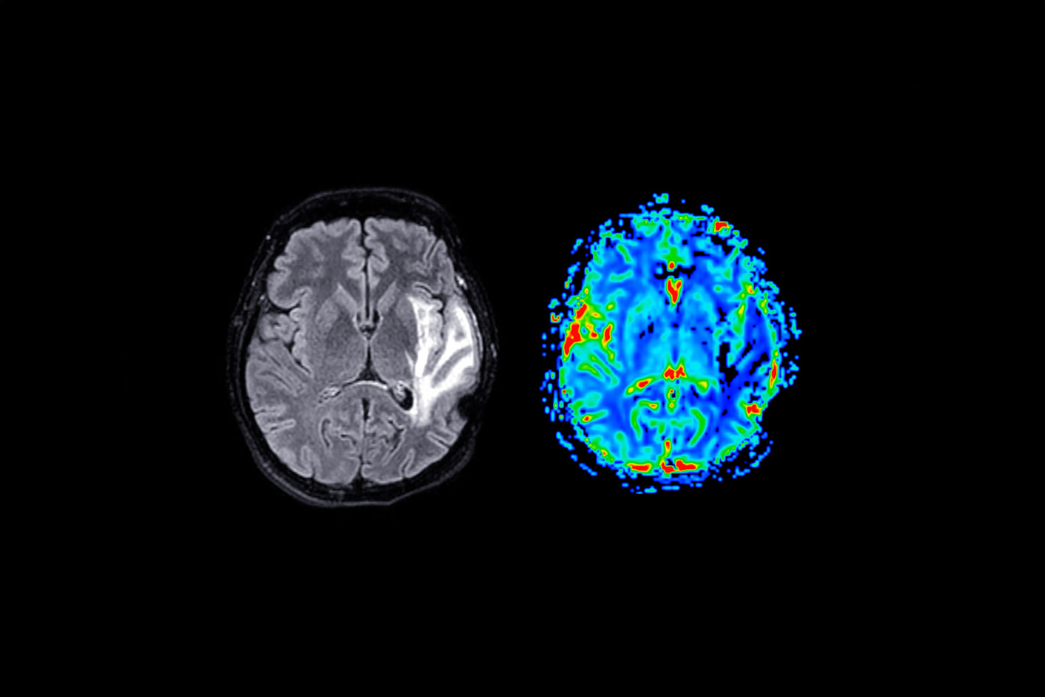 Distinct Brain Features in Football Players May Tell Who Is at Risk of ...